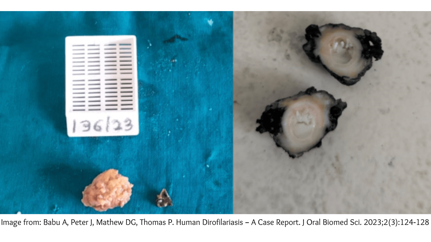 Dirofilariasis – THE PATHOLOGY CHRONICLES