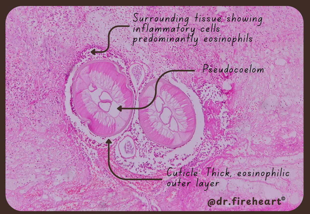 Dirofilariasis – THE PATHOLOGY CHRONICLES