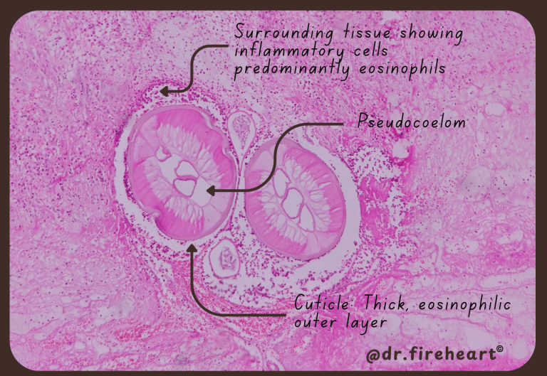 Dirofilariasis – THE PATHOLOGY CHRONICLES